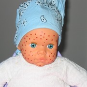 La varicelle, la maladie infantile classique